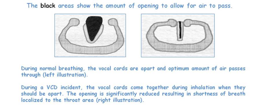 vcd-vocal-cord-drawing-v6 – Vocal Cord Dysfunction